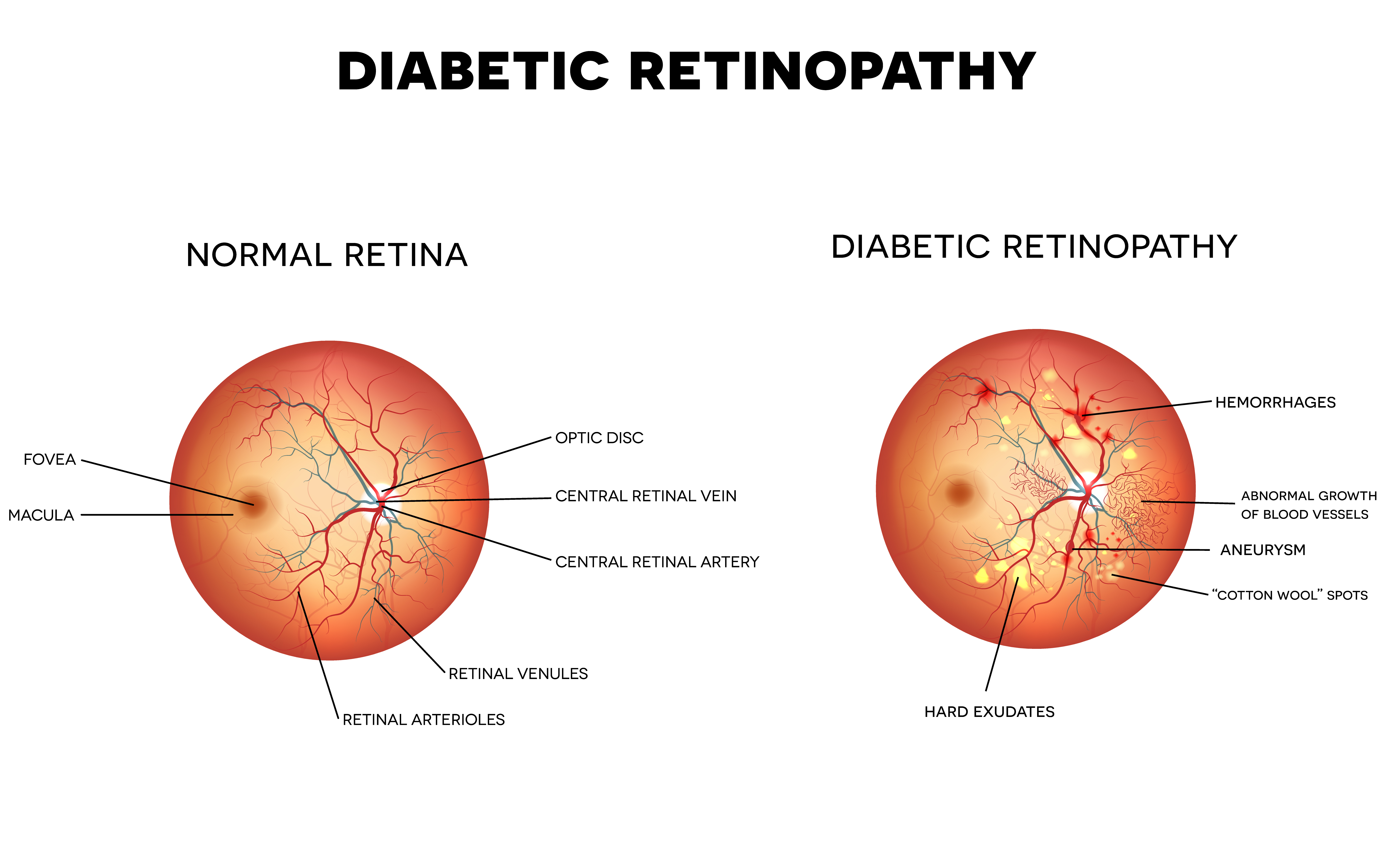 Diabetic Retinopathy Analysis Using Fundus Images Myprofile