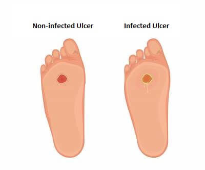 How To Manage Foot Ulcer
