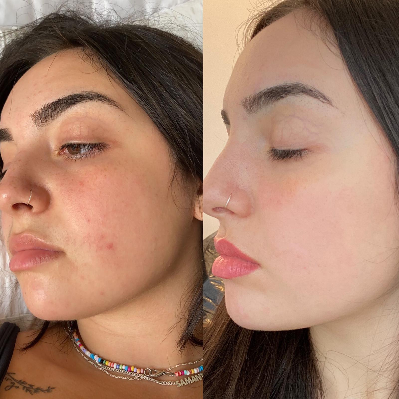 intense-pulsed-light-15-30-mins