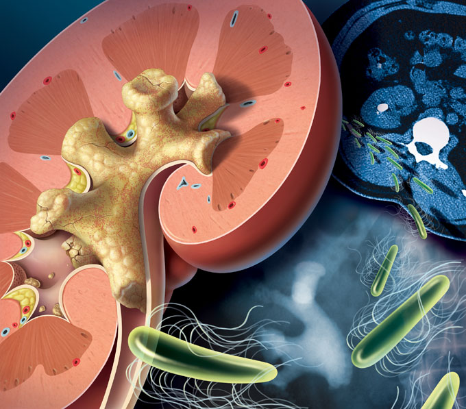 Kidney Stone Management at BlueGrass Renal Care