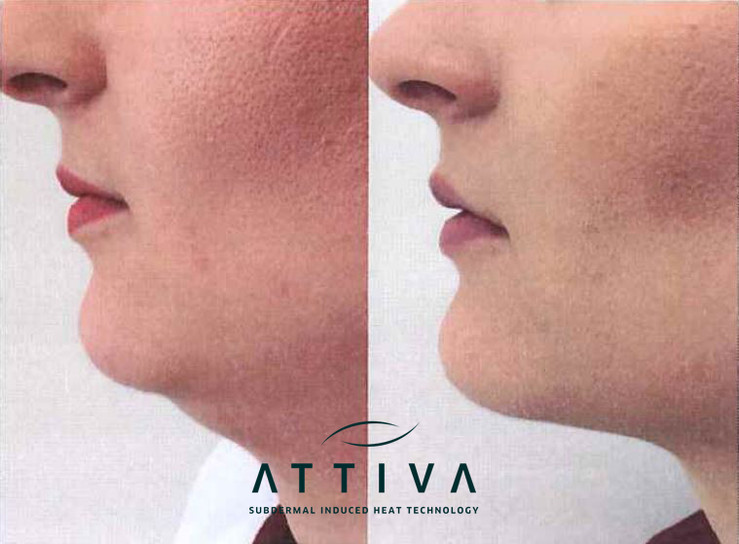Attiva RF-Attiva USA-Facelift-Liposuction | ASVCC