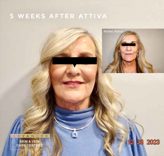 Attiva RF-Attiva USA-Facelift-Liposuction | ASVCC