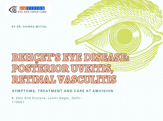 Behçet’s Eye Disease Care in Delhi: Posterior Uveitis & Retinal Vasculitis