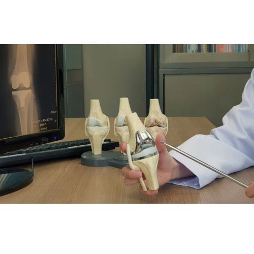 MAKO robot-assisted total knee arthroplasty versus conventional manual ...