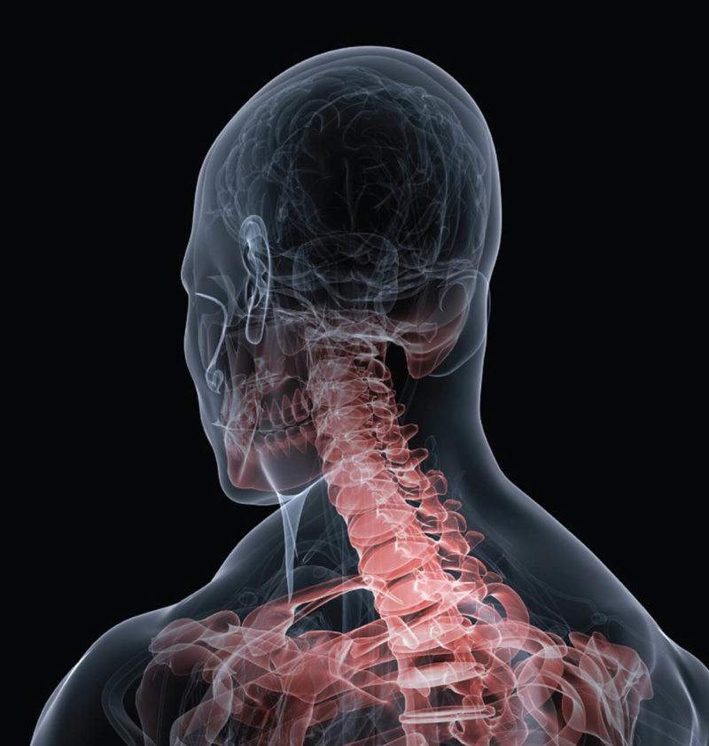 Chronic Neck Pain in Women