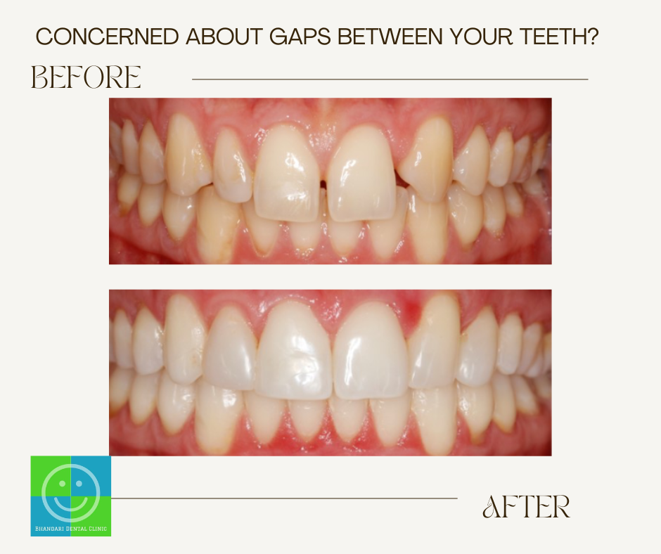 Fixing Gaps Between Teeth