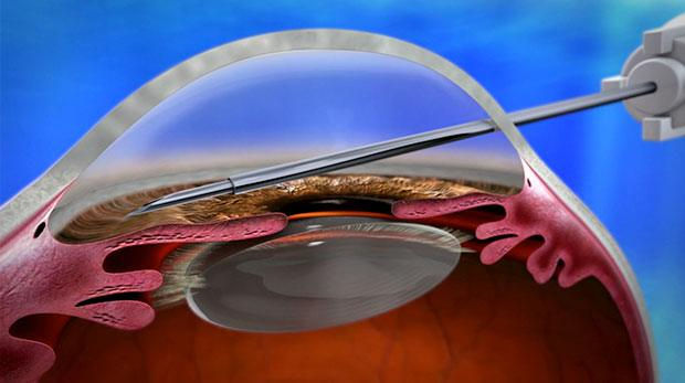 Glaucoma Services | IRIS Eye Care
