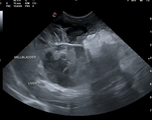 Gallbladder Mucocele