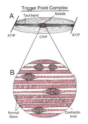 Trigger points - an explanation