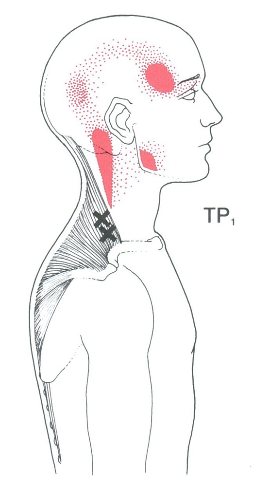 Trigger points - an explanation