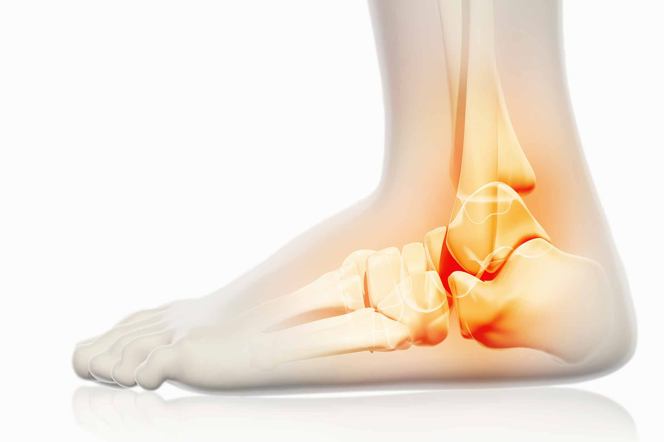 ANKLE ARTHRITIS