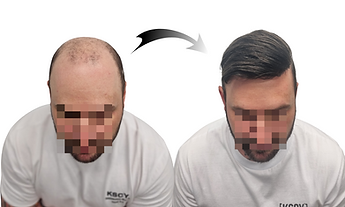 Hair Systems Gold Coast | Hair Systems Brisbane | Rephair | Robina