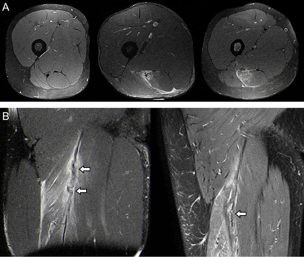 Intramuscular Tendon Tears of the Hamstrings
