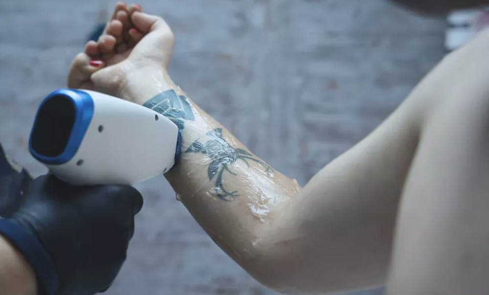 Tattoo Removal: Everything You Need to Know