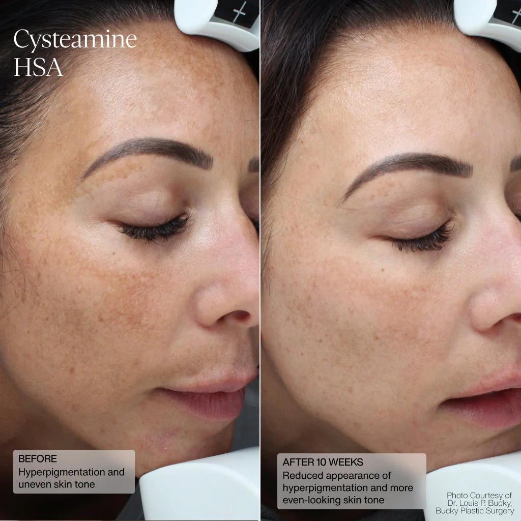 Cystamine | Divina Dermatology