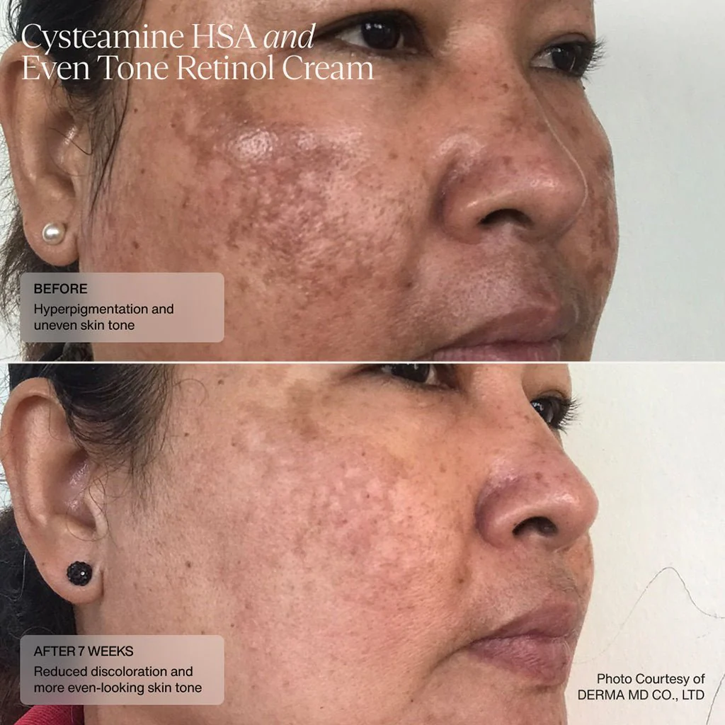 Cystamine | Divina Dermatology