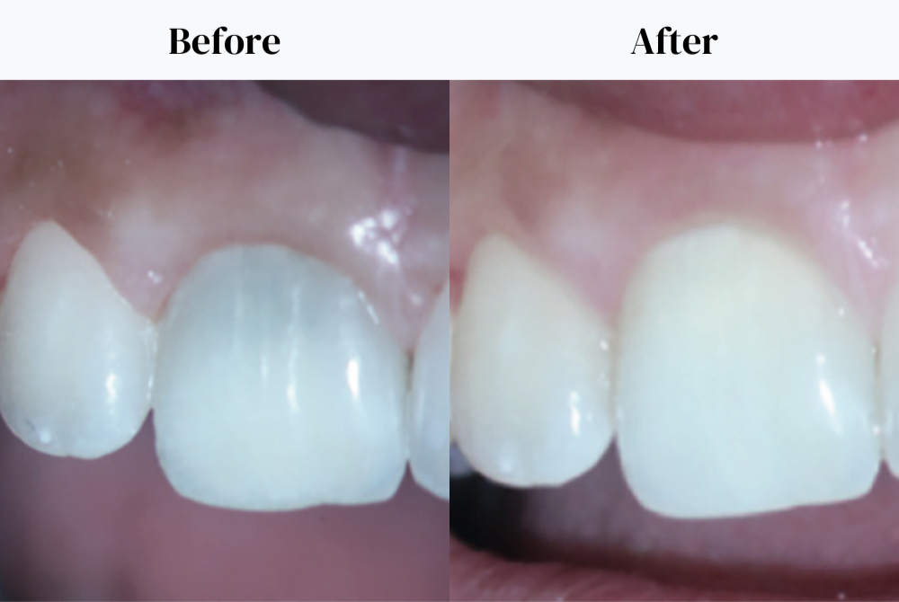 Internal Bleaching in Midtown Manhattan, NY - Clear Endodontics