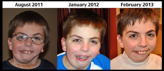 overbite before and after