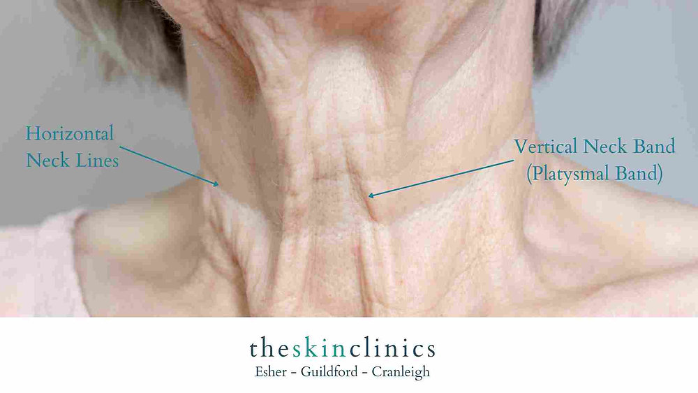 I have neck lines - how do I treat them?
