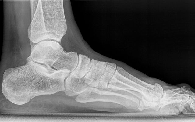 calcaneal apophysitis