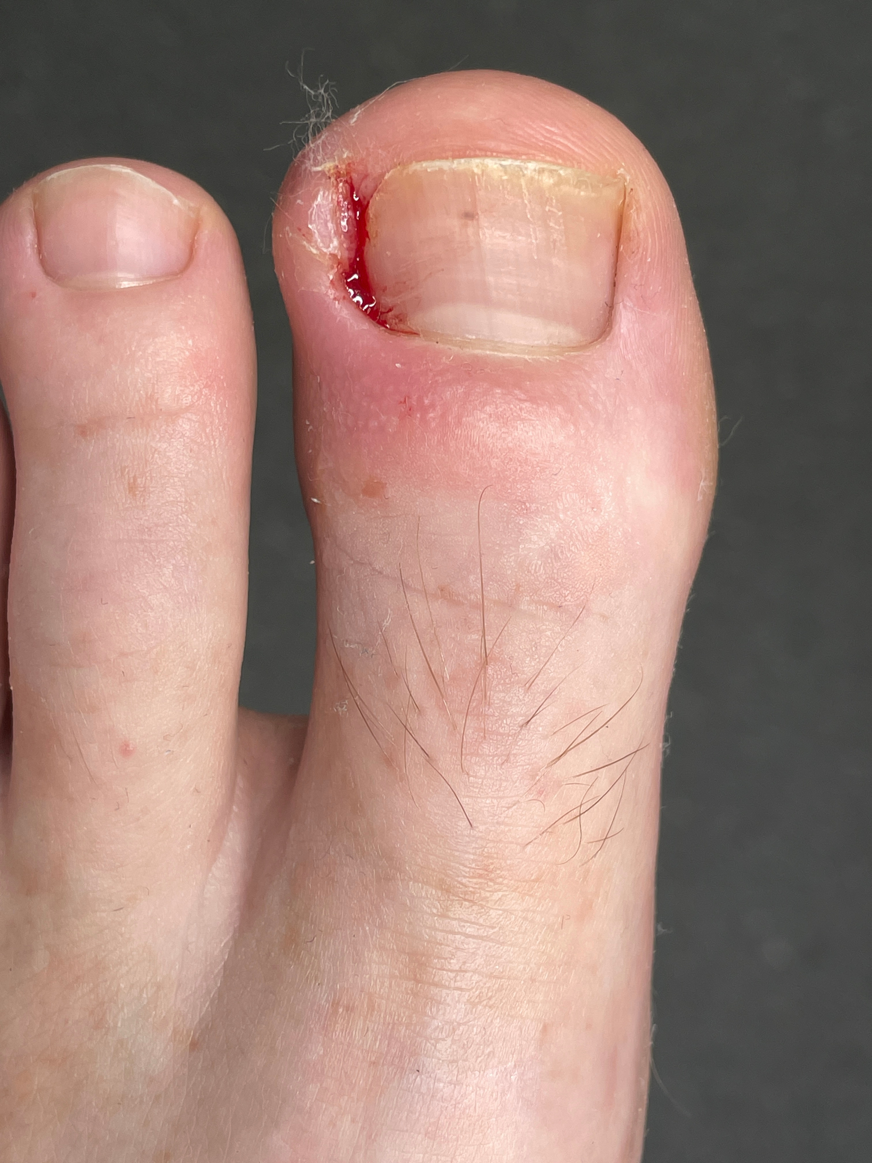 Nail Surgery at Keep On Your Feet Podiatry in Swansea