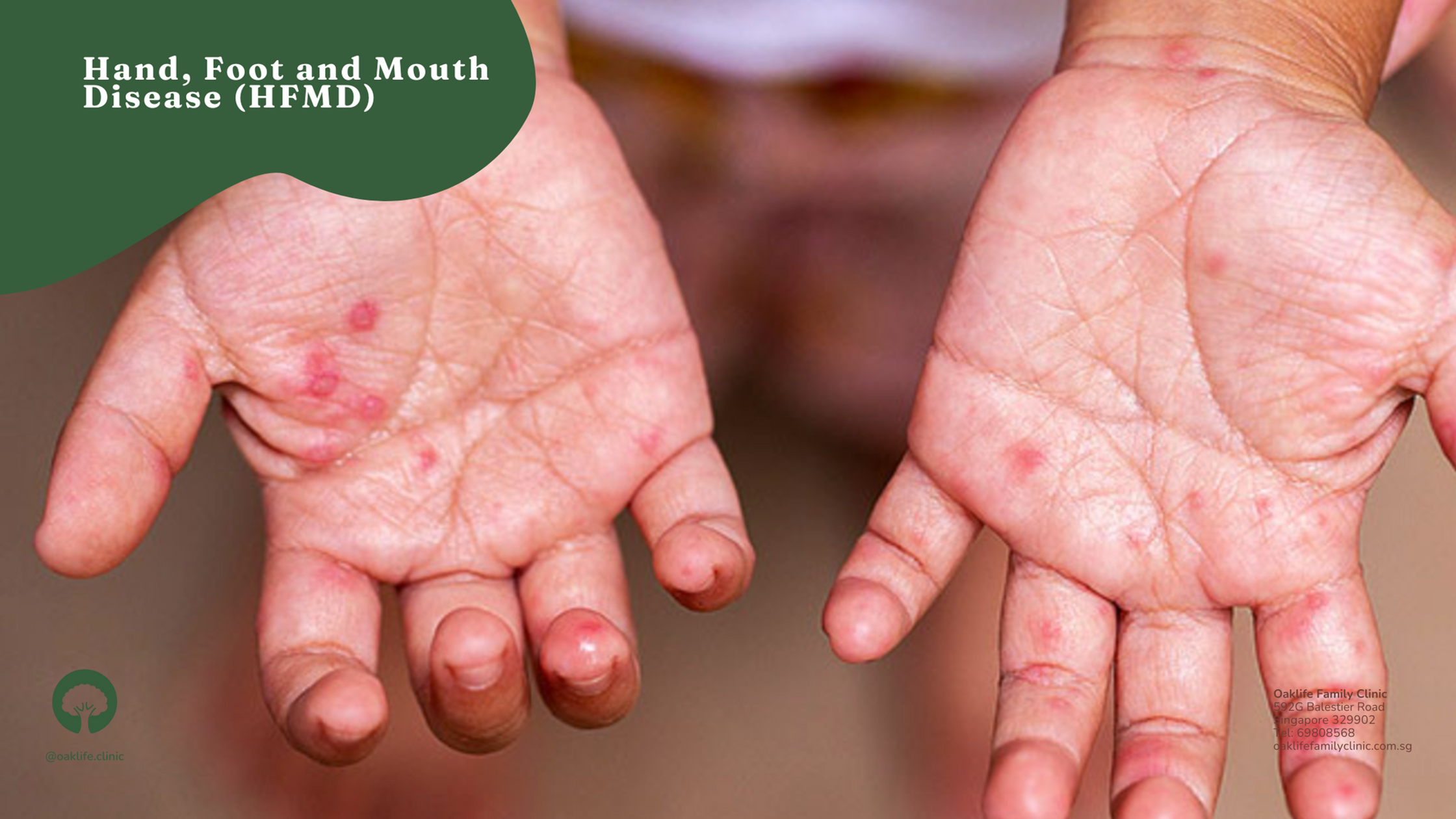 HFMD in Kids: Recovery Tips & Prevention | Oaklife Family Clinic