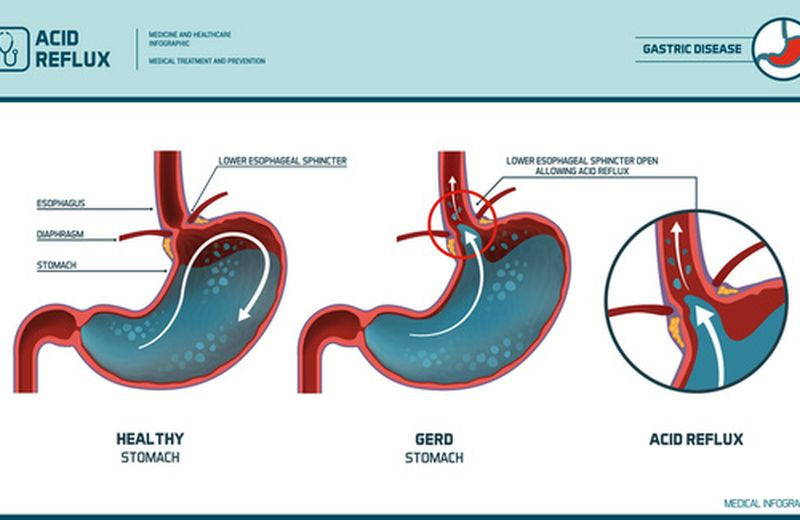 TERAPIA ANTIREFLUSSO