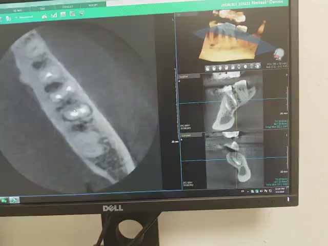 Using CBCT scan to evaluate fracture tooth