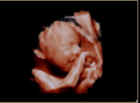 3d 4d Ultrasounds | Bundle Of Joy Ultrasound | La Farge