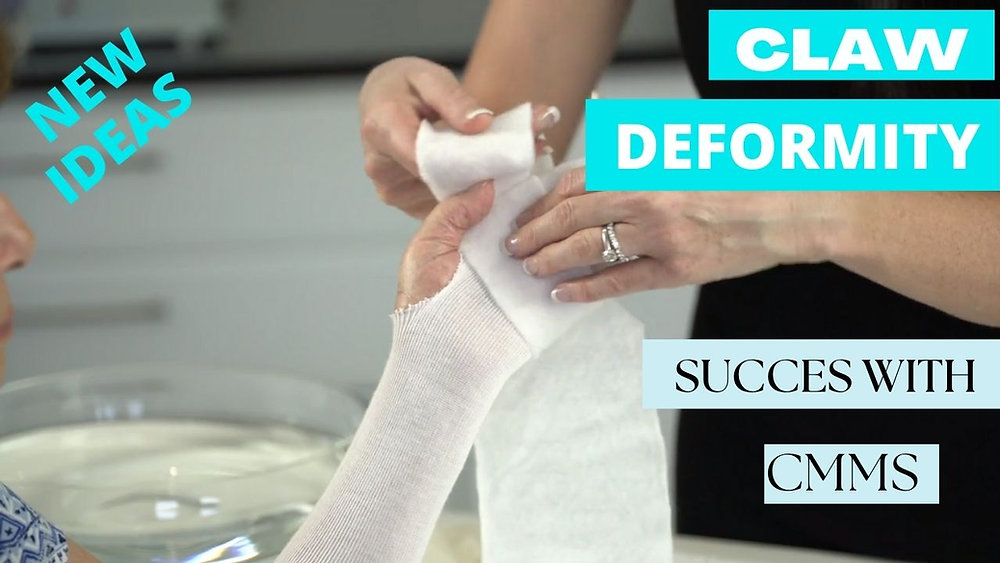 Claw Deformity? Try a New Technique