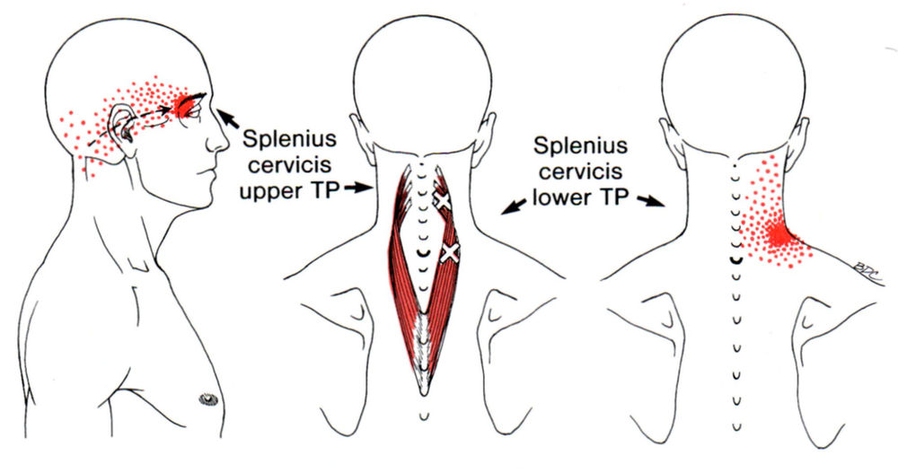The Trigger Point & Referred Pain Guide # 13