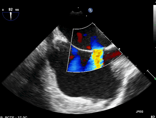 COMUNICACIÓN INTERAURICULAR