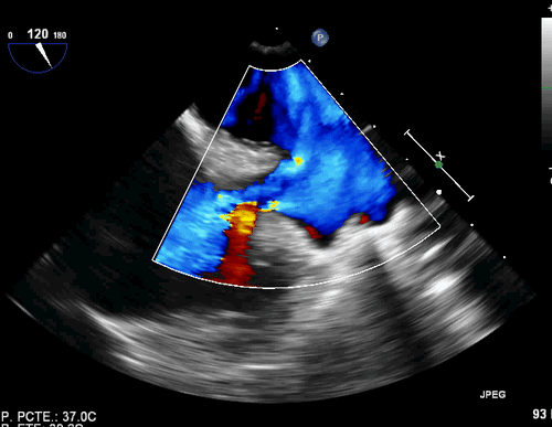 COMUNICACIÓN INTERAURICULAR