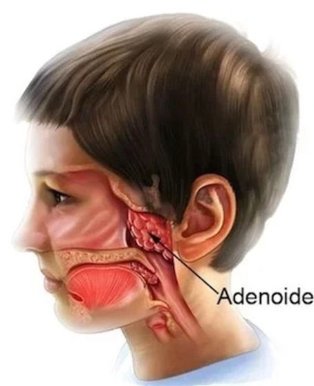 Saiba um pouco mais sobre a adenoide