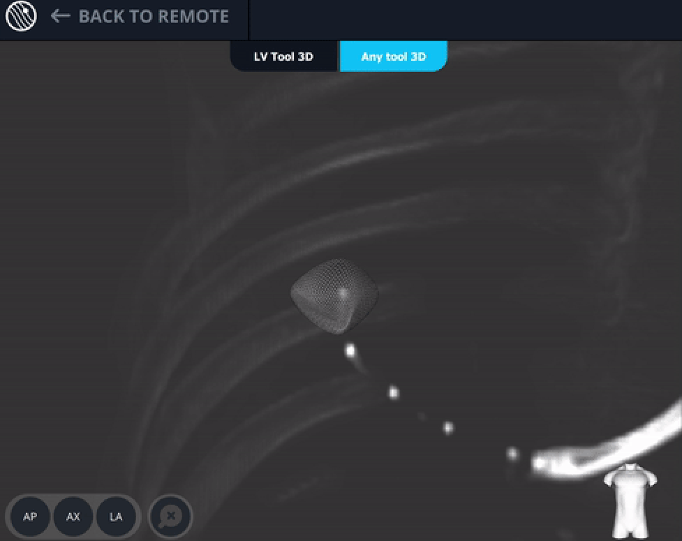 Biopsy and Diagnosis of an 18mm RUL Lesion | Body Vision Medical