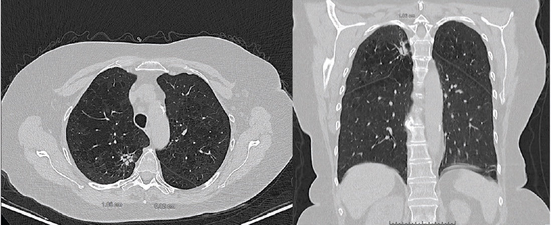 Real-Time, Image-Guided Cryobiopsy and Diagnosis of a 10mm Right Upper ...
