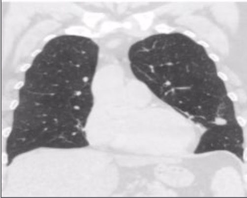 Overcoming CT-to-Body Divergence and Diagnosis of a 13mm Left Upper ...