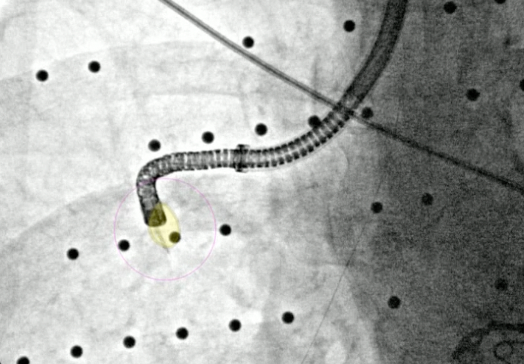 Biopsy, Diagnosis and Fiducial Marker Placement of a 10mm RUL Lesion ...