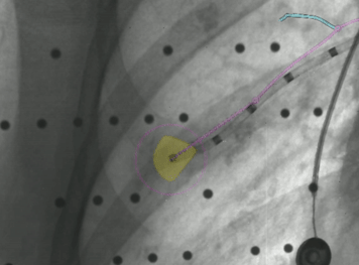 Biopsy and Diagnosis of a 12 mm (LUL) and 15 mm (RML) Lesion | Body ...
