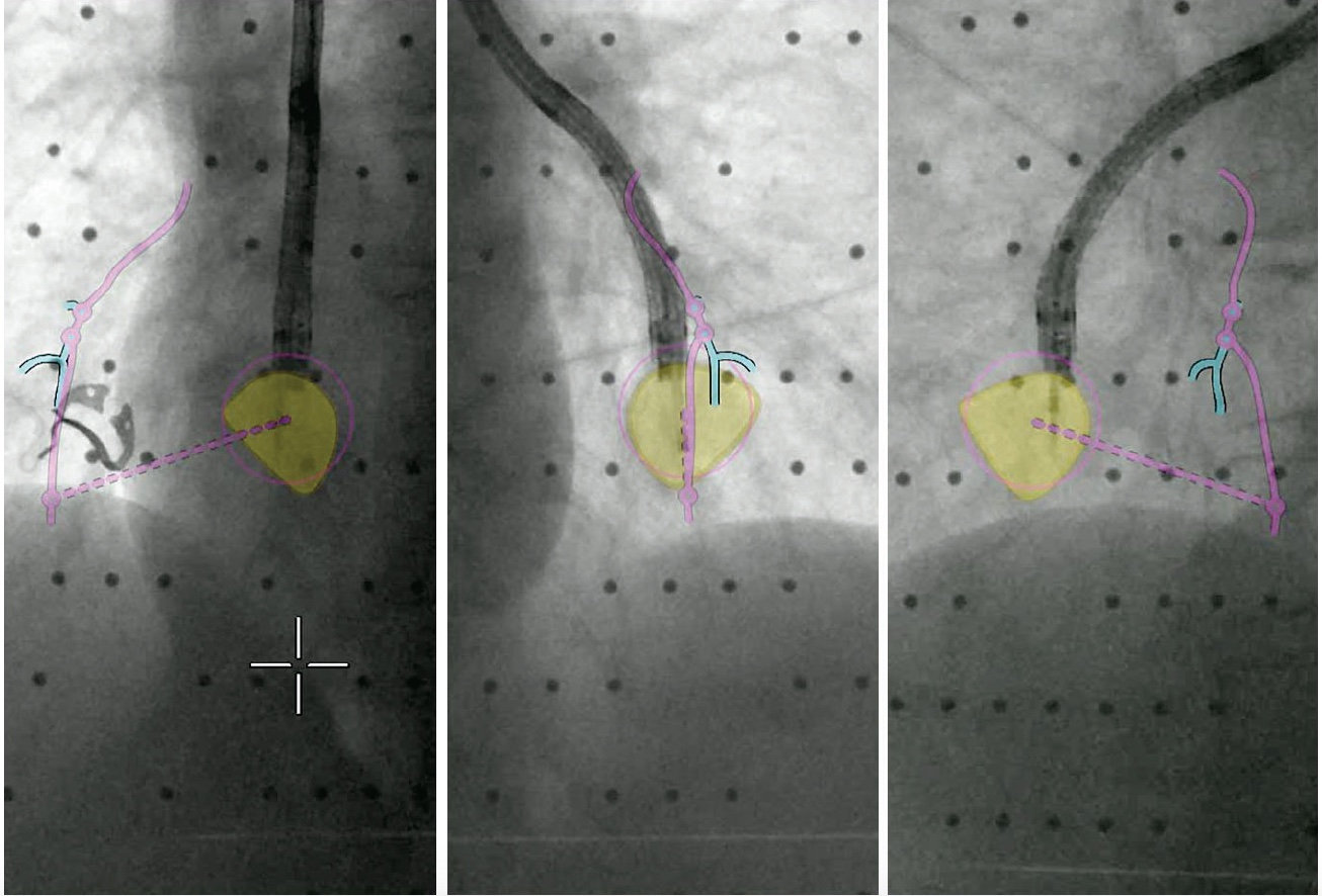 Transbronchial Needle Aspiration of a Right Middle Lobe (RML) Lesion ...