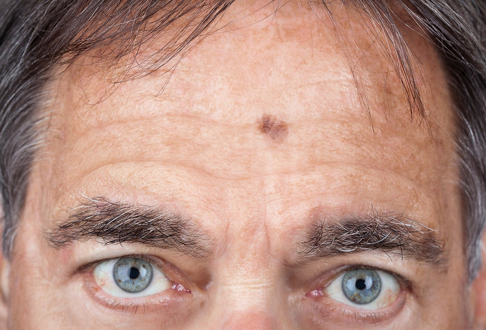 Why Brown Spots Matter: from a Board-certified Dermatologist