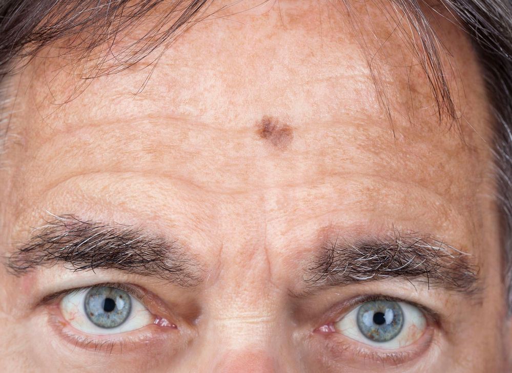 Spotting Skin Cancer&Melanoma Early