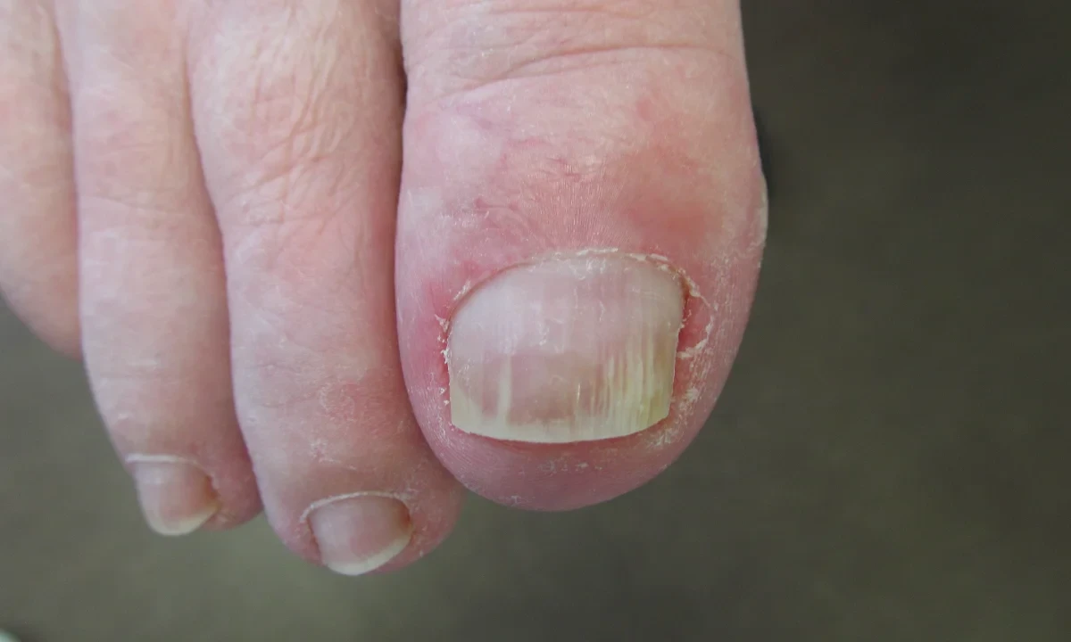 Fingernagelpilz selbst behandeln - So schaffst Du das!