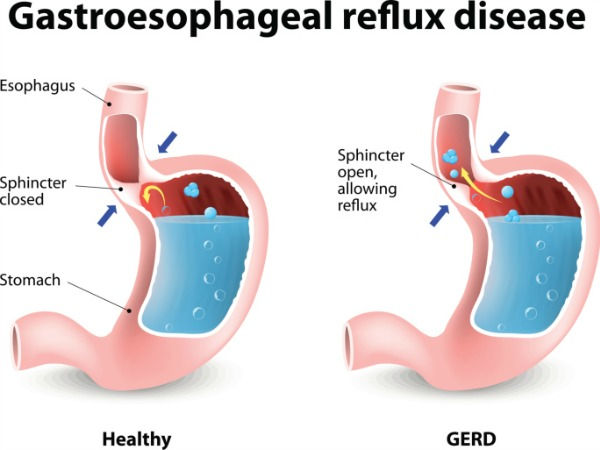 GERD: Gastroesophageal Reflux Disease