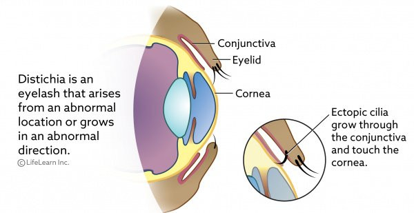 What in the world is Distichiasis