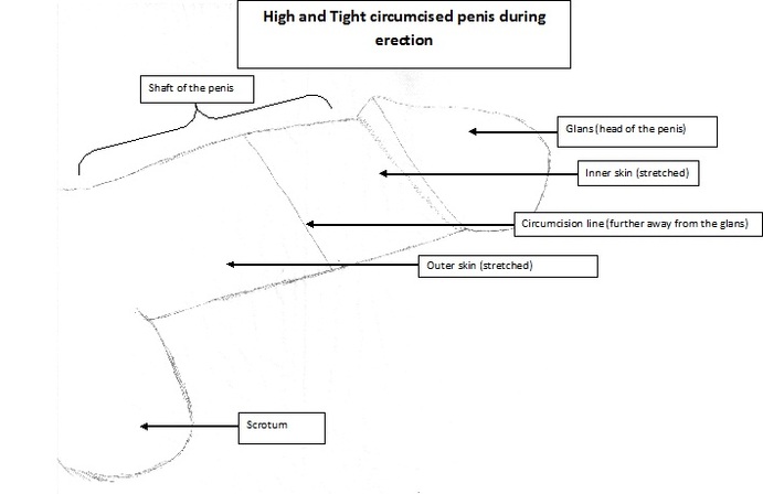 Different Types Of Circumcision – CYVS
