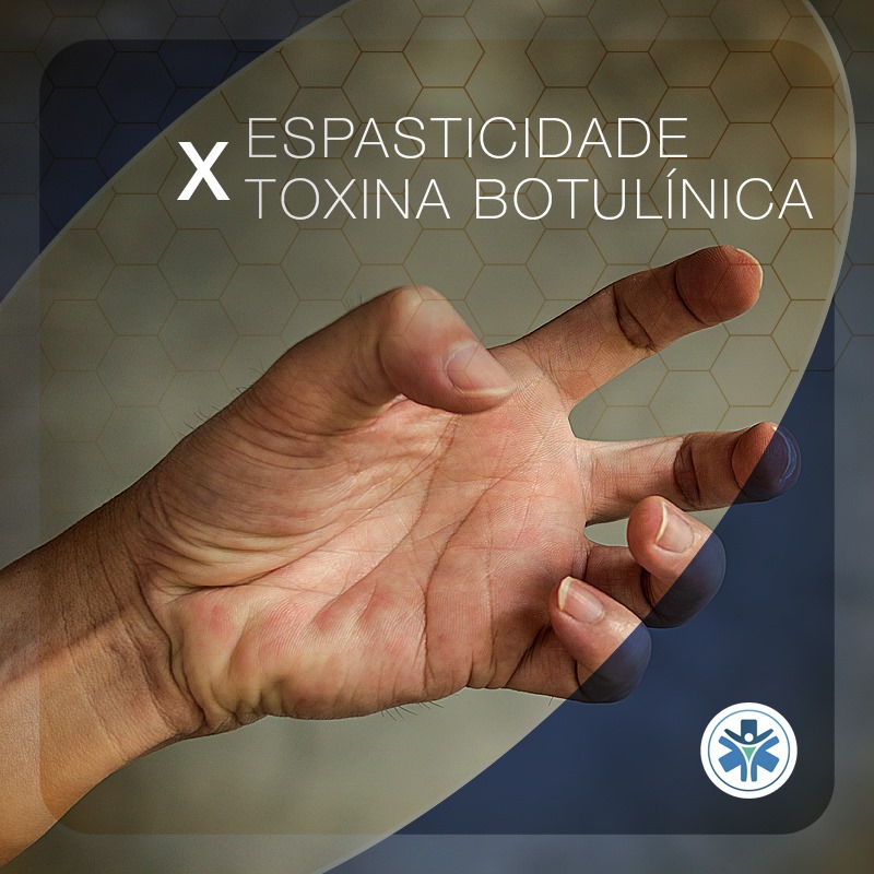 Espasticidade X Toxina Botulínica