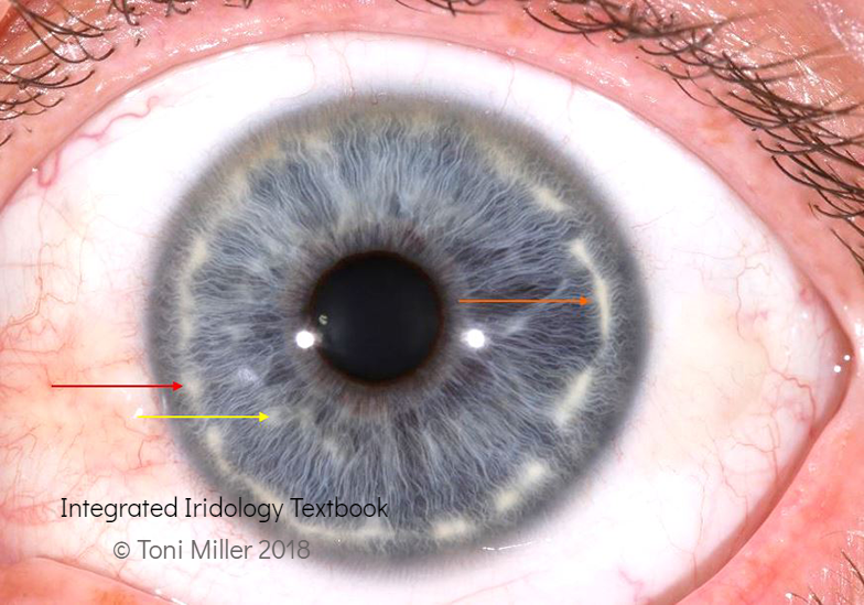 Understanding Iridology Lymphatic Tophi - Integrated Iridology