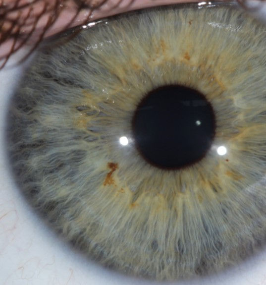 Does the iris change? Part 2.