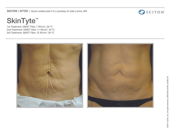 Skin Tyte | Dermatology Associates of Macomb-Oakland